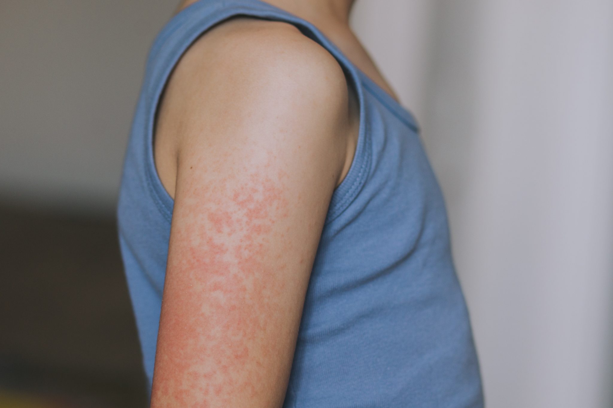 Measles (Disease Index) - NICD